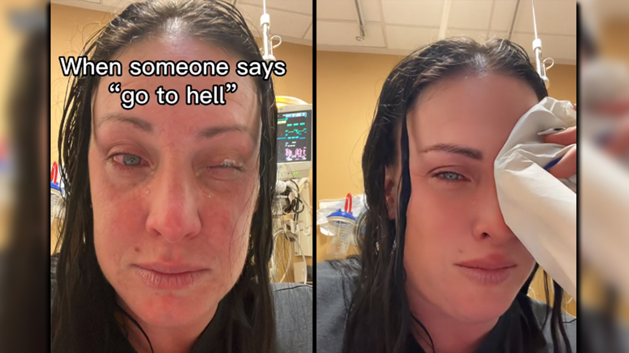 ¡Con los ojos pegados! Así quedó mujer que confundió gotas para ojos ...