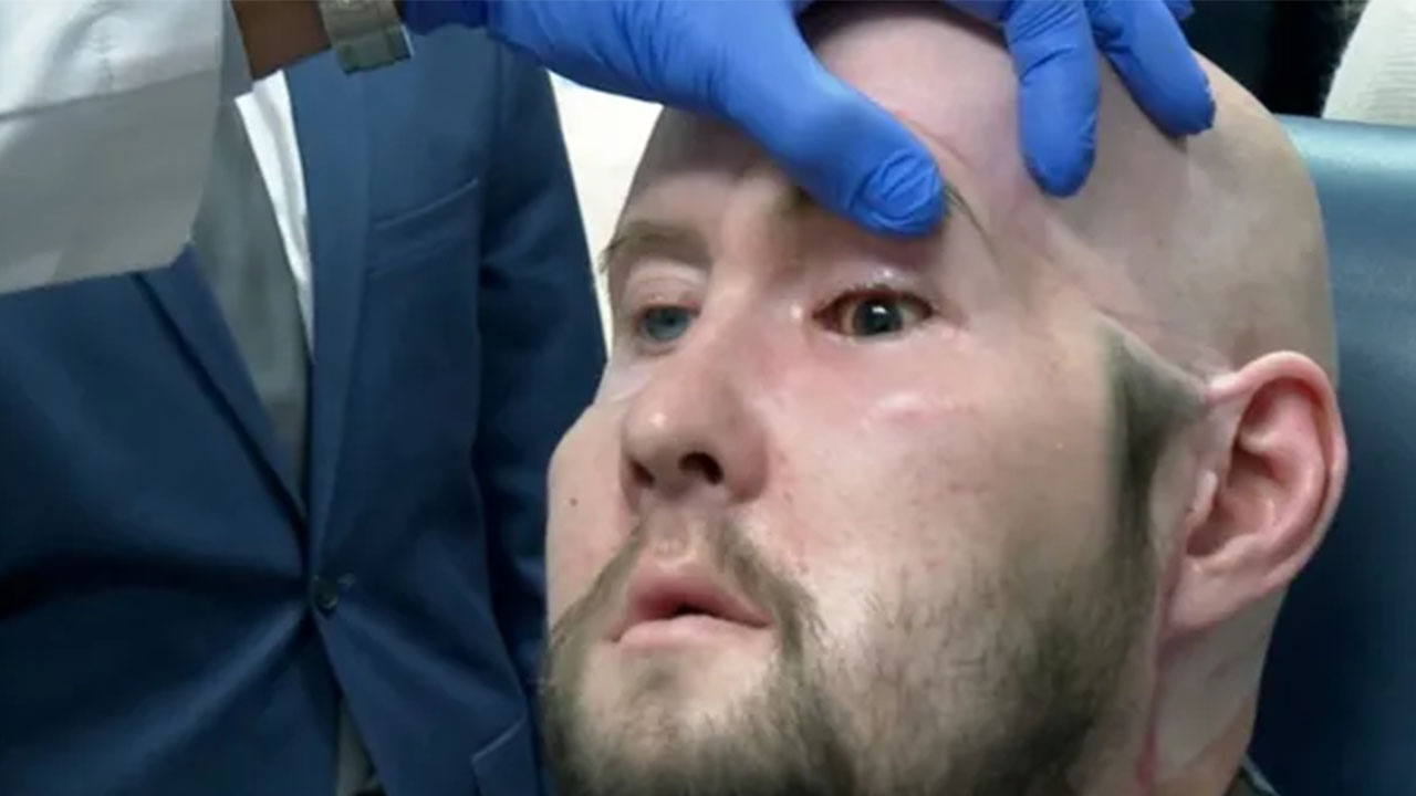 ¡Un avance en la medicina! Se realizó el primer trasplante de ojo completo en el mundo | Minuto30